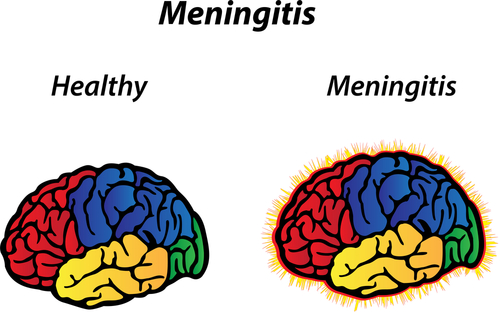 Meningitis: A Rare But Serious Condition | AllDayChemist Online ...