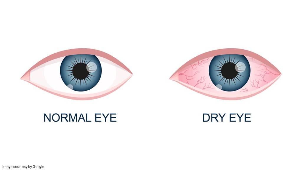 Understanding Dry Eye Symptoms & Best Solution for Dry Eyes