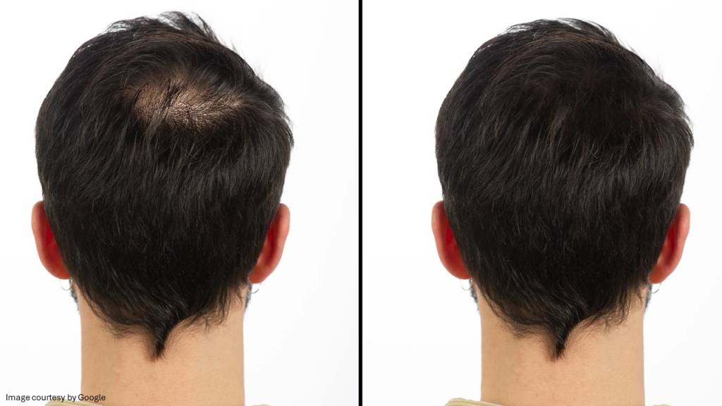 Propecia for Thinning Hair: Is It the Ultimate Solution? | AllDayChemist