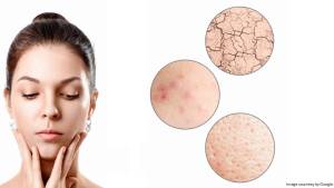 Tazret Gel Benefits & Side Effects | All About Tazorac Gel