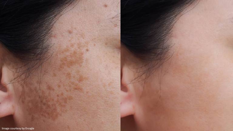 Dark Spots & Hyperpigmentation: Treatment Options That Work